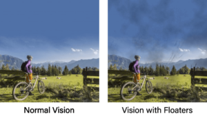 Retinal Detachment - Vitreo-Retinal Consultants